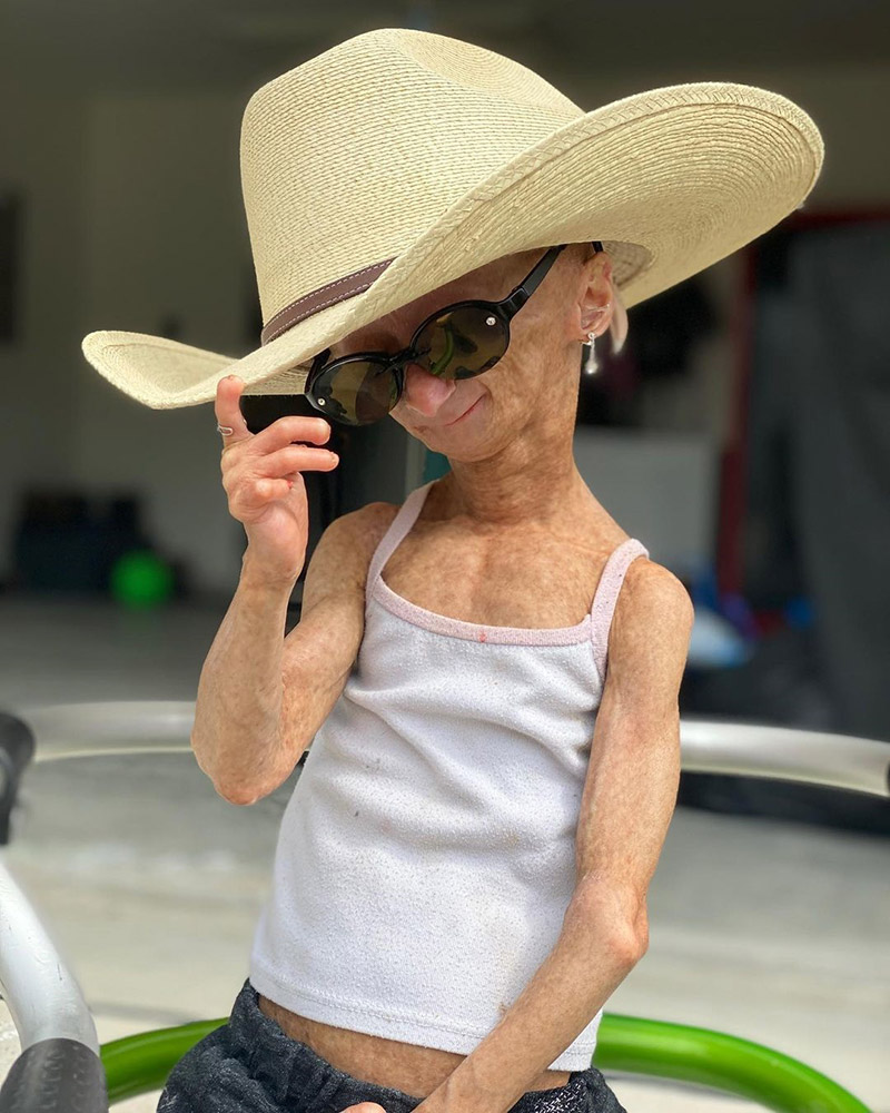 Adalia Rose ยูทูบเบอร์สาวป่วยแปลก โรคโพรจีเรีย แก่ตั้งแต่เด็ก เสียชีวิต ...
